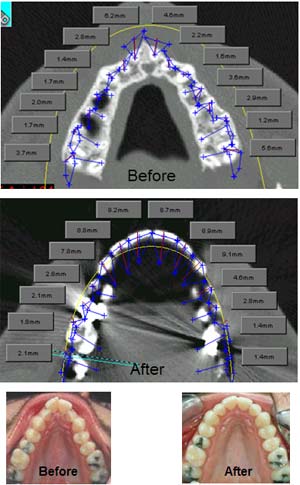 The Periodontally “Accelerated Osteogenic Orthodontics” Technique